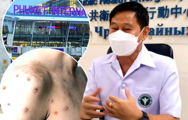 German’s girlfriend negative for monkeypox - Thai Examiner